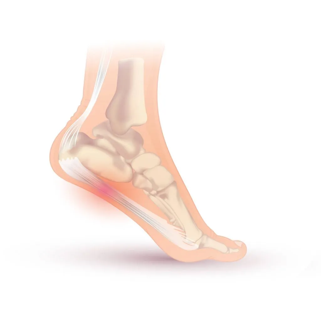 Metatarsalgia (Pain in the Ball of Your Foot): Causes & Treatment