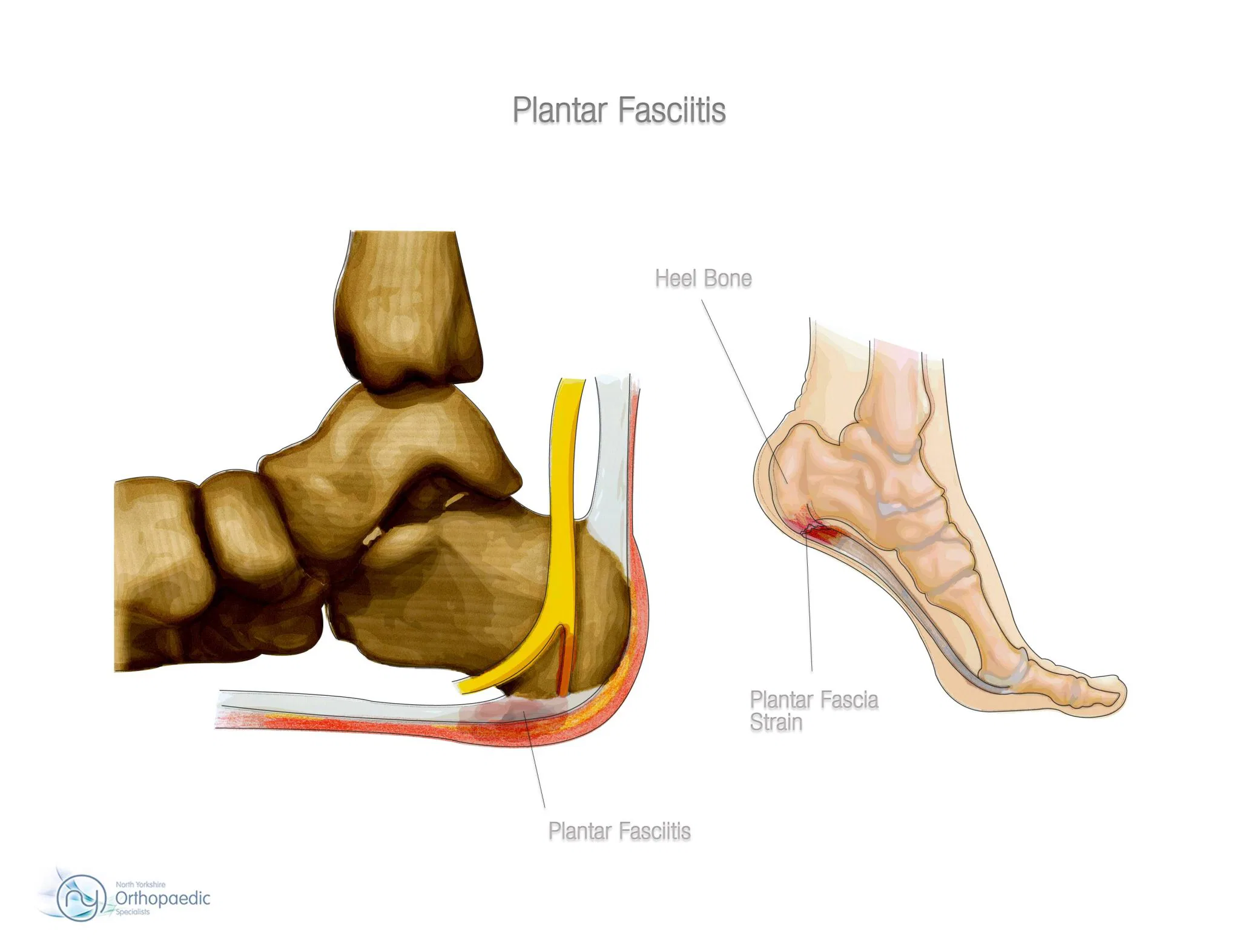 How to Wrap Foot For Plantar Fasciitis With ACE Bandage