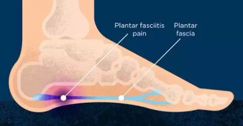 Plantar Fasciitis Stretches and Exercises
