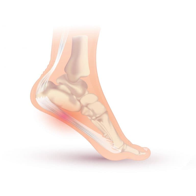 How to Wrap Foot For Plantar Fasciitis With ACE Bandage